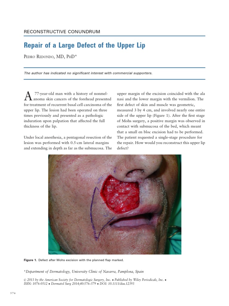 Repair of A Large Defect of The Upper Lip | PDF | Business | Wellness