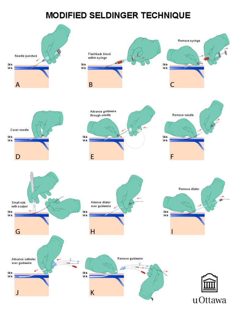 Modified Seldinger Technique: Remove Syringe | PDF