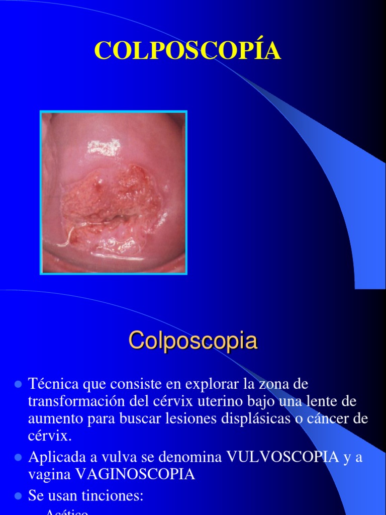 Colposcopia Basica | Medicina | Enfermedades y trastornos