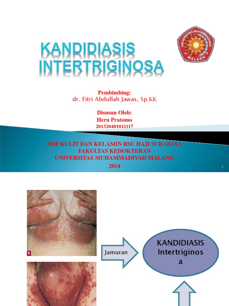 Kandidiasis Intertriginosa | PDF