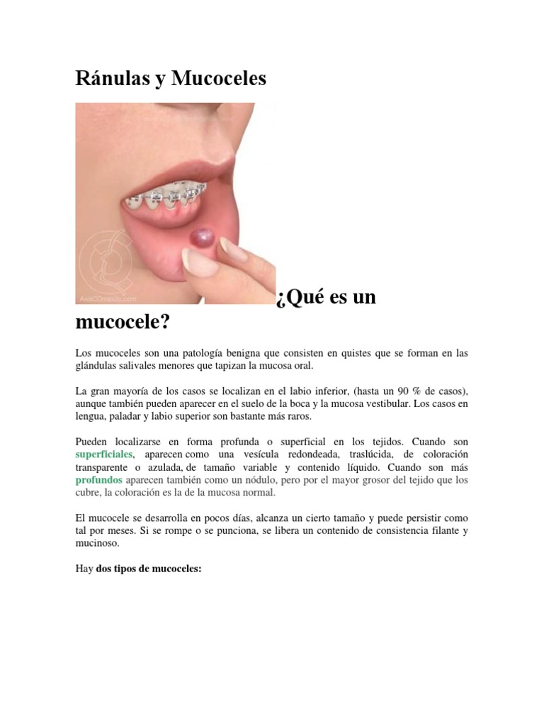 Ránulas y Mucoceles | PDF | Especialidades Medicas | Medicina CLINICA