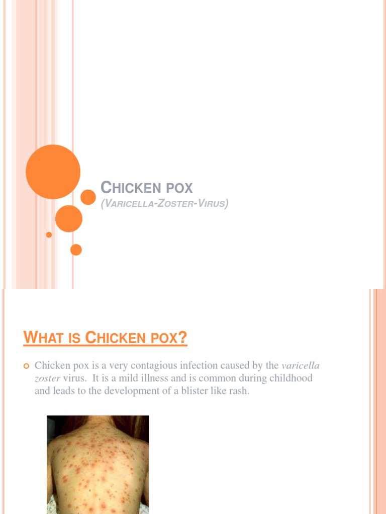 Chicken Pox Powerpoint | PDF