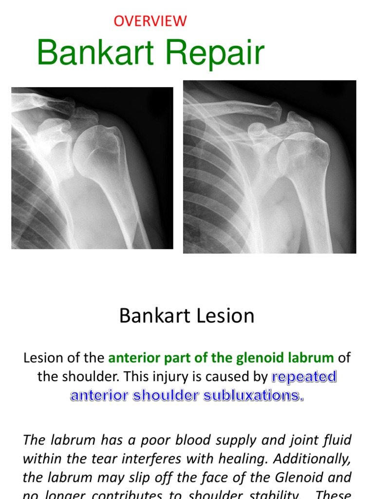 Bankart PPT | Shoulder | Limbs (Anatomy)