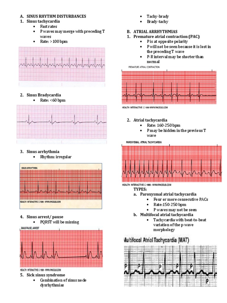 Sinus Rhythm Disturbances Explained | PDF | Heart Rate | Cardiac Arrhythmia