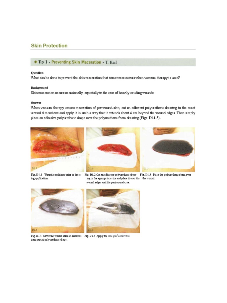 Tips of Operations - VAC Therapy | PDF | Wound | Foam