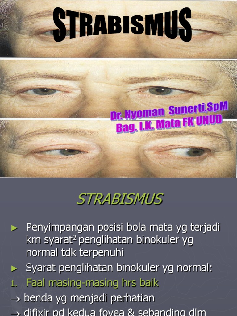 Strabismus | PDF