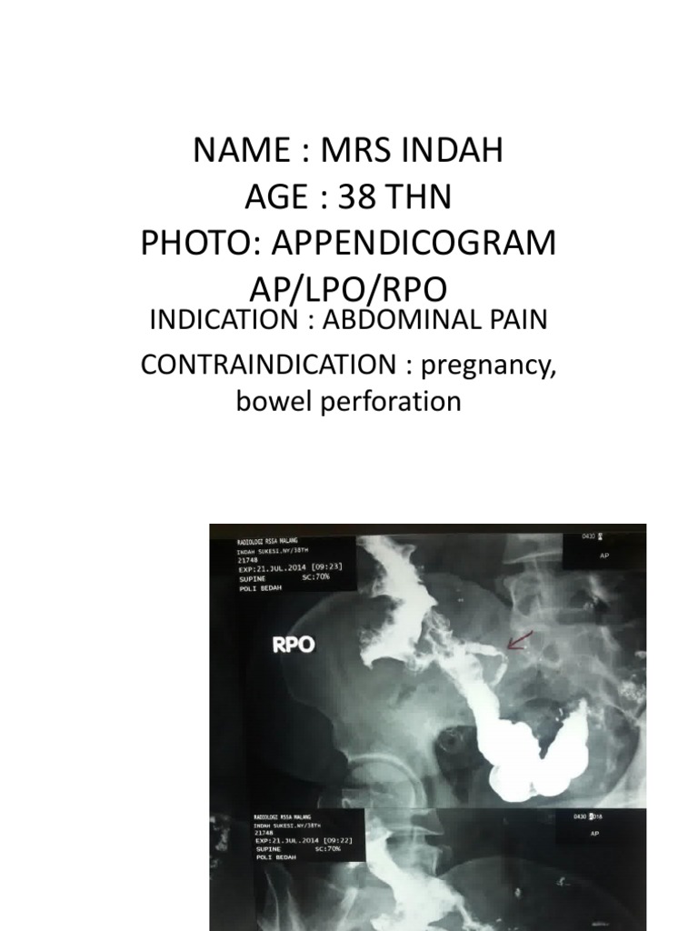 Appendicogram Results for Abdominal Pain | PDF
