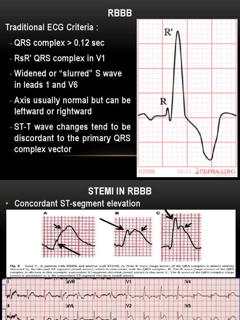 RBBB and ST-Elevation Criteria | PDF