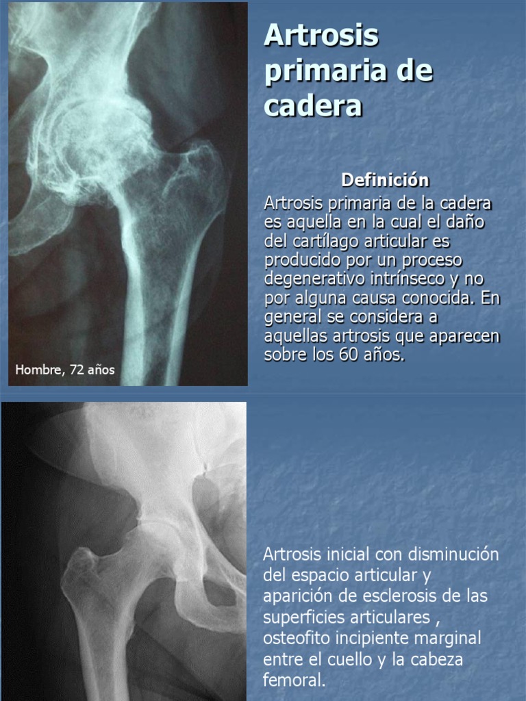 Artrosis Primaria de Cadera: Síntomas y Clasificación | PDF | Cadera ...