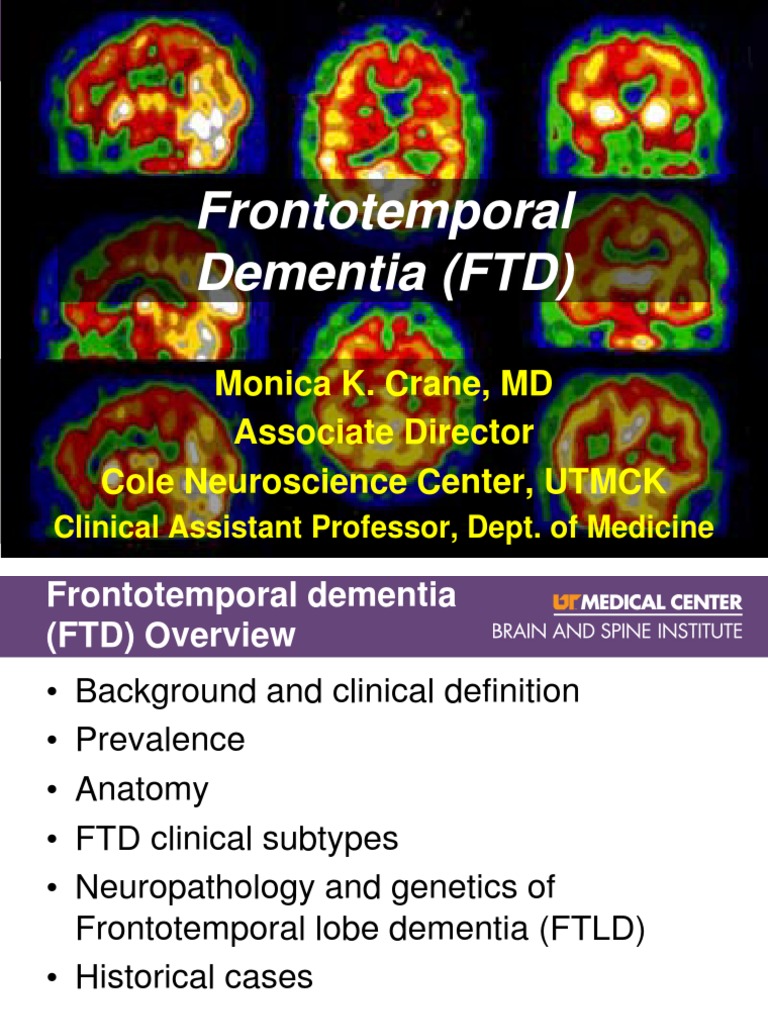Frontotemporal Dementia Talk | PDF | Dementia | Amyotrophic Lateral ...