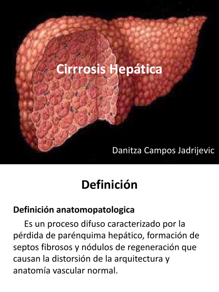 cirrosis presentacion .ppt | Cirrosis | Hepatitis
