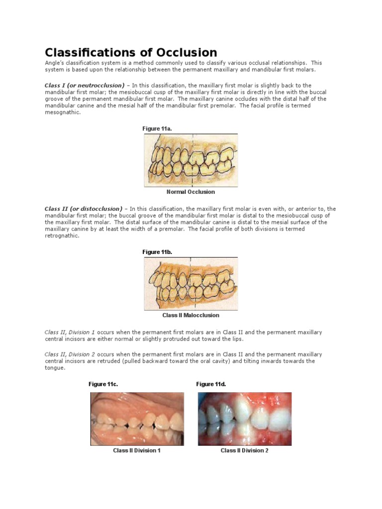 Classifications of Occlusion | Human Anatomy | Mouth | Free 30-day ...