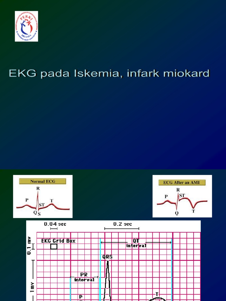 Gambaran EKG pada Infark Miokard | PDF