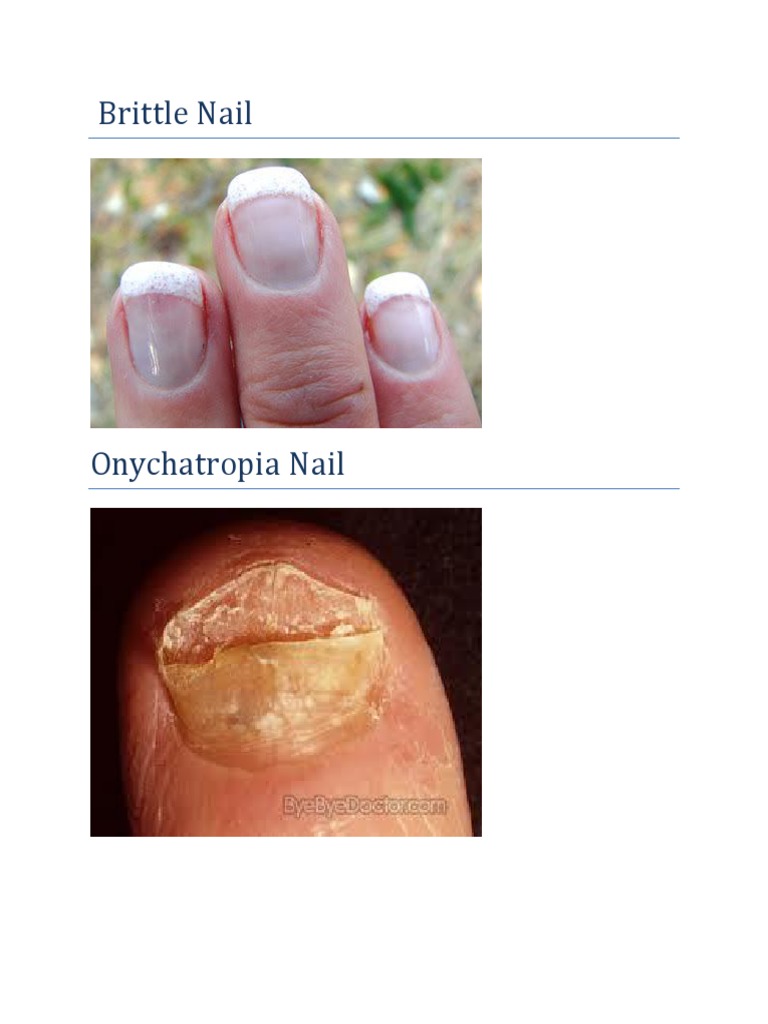 Brittle & Onychatropia Nails Guide | PDF