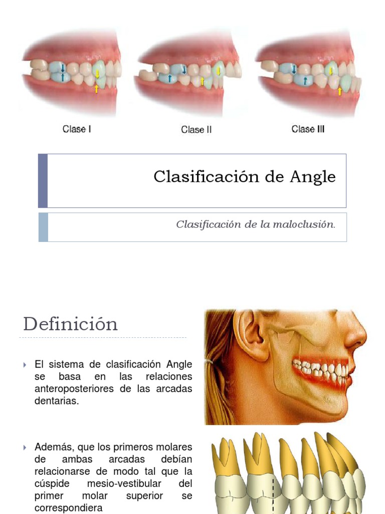 Clasificación de Angle.pptx
