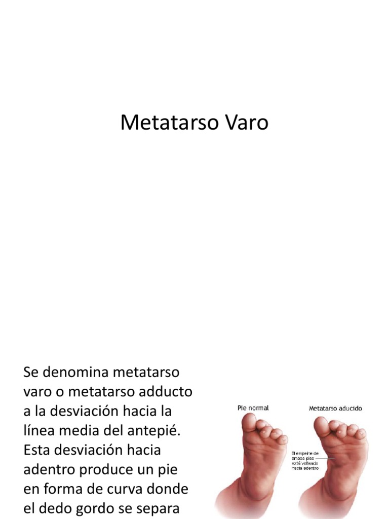 Metatarso Varo | PDF | Pie | Anatomía del miembro inferior