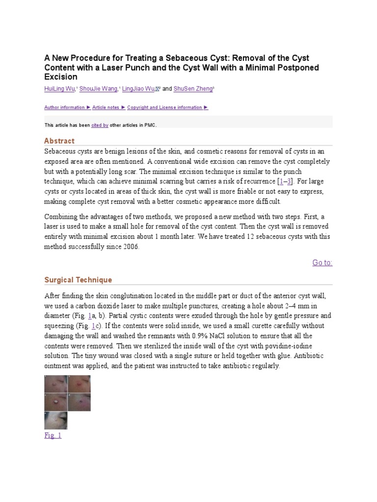A New Procedure For Treating A Sebaceous Cyst | PDF | Surgery | Scar