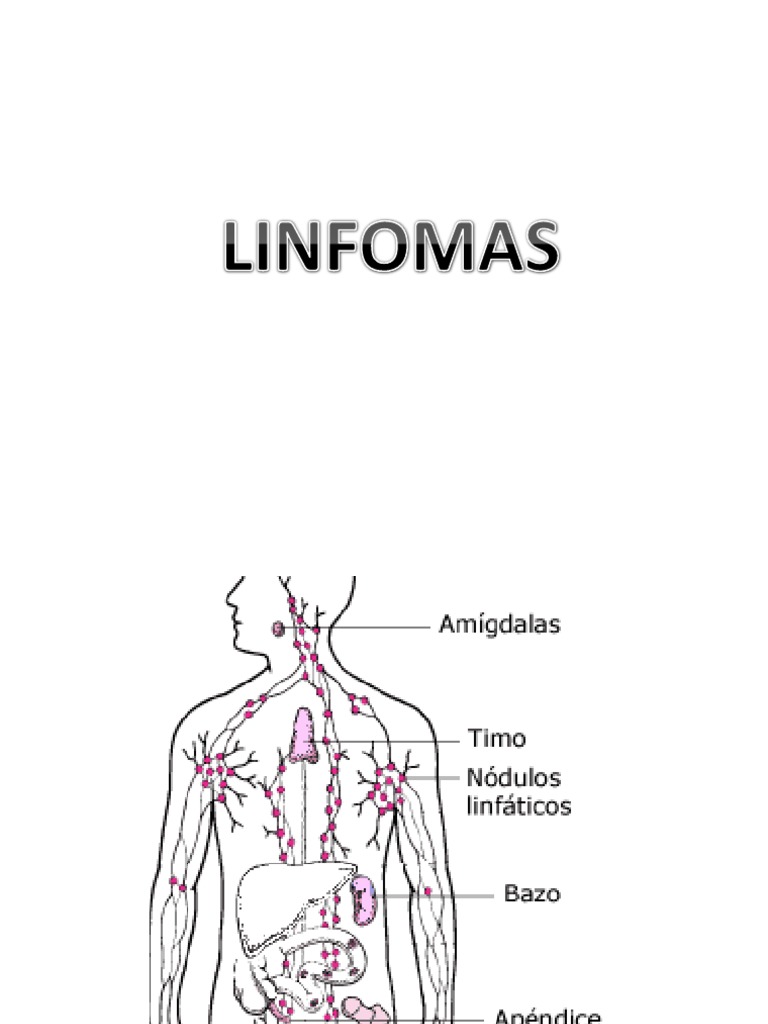 Linfomas de Celulas B Grandes Difusas | PDF | Linfoma | Leucemia