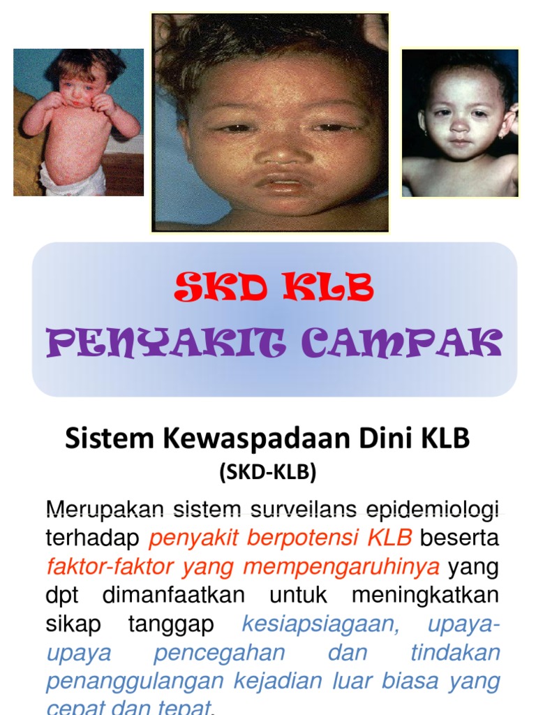 SKD KLB Campak | PDF | Sains & Matematika