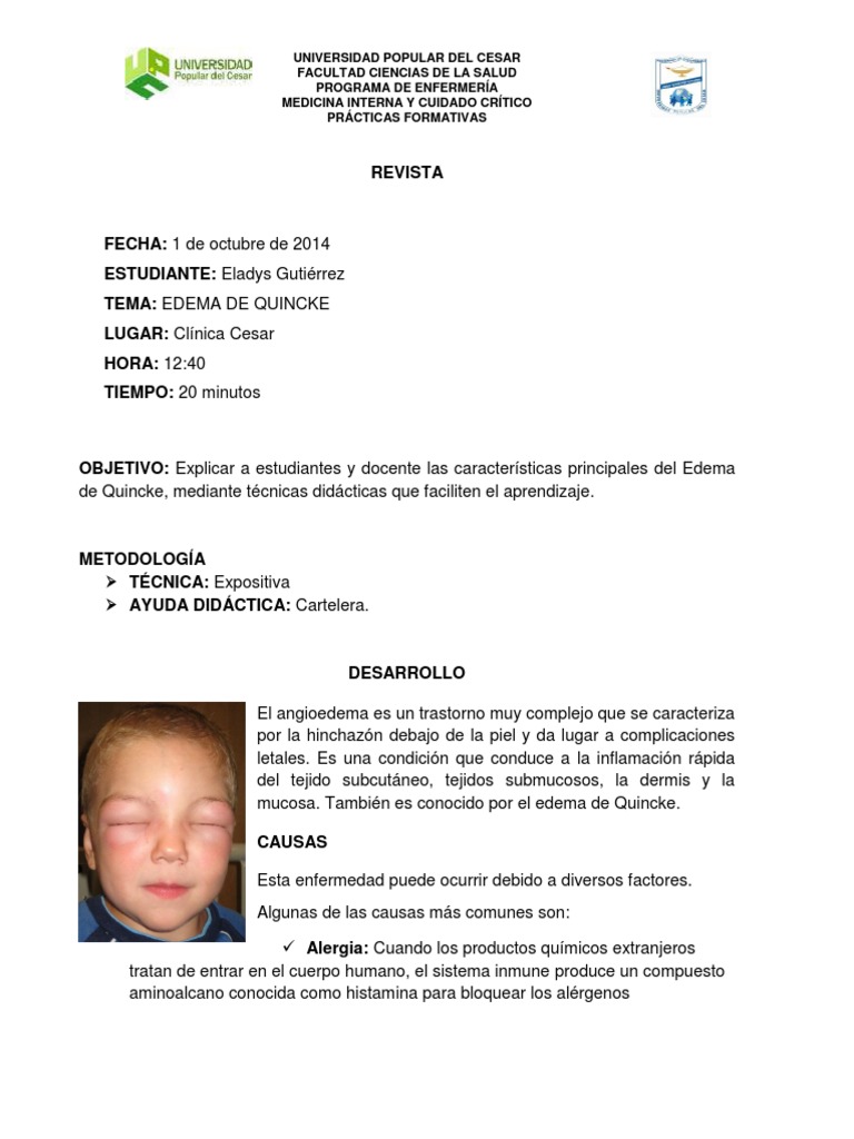 Angioedema de Quincke: Causas, Síntomas, Diagnóstico, Tratamiento y ...