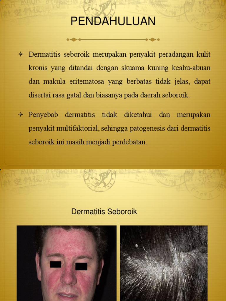 Dermatitis Seboroik | PDF