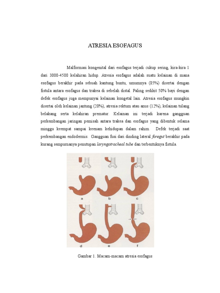 Atresia Esofagus | PDF