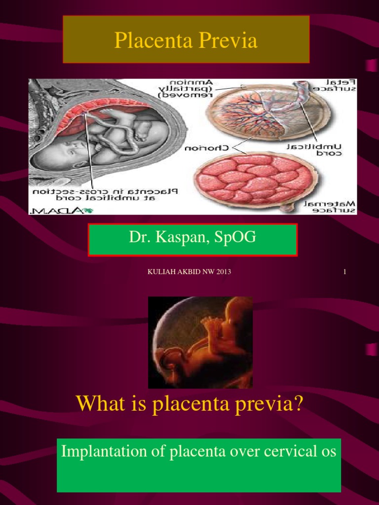 PLASENTA PREVIA 2.ppt | Placenta | Health Sciences