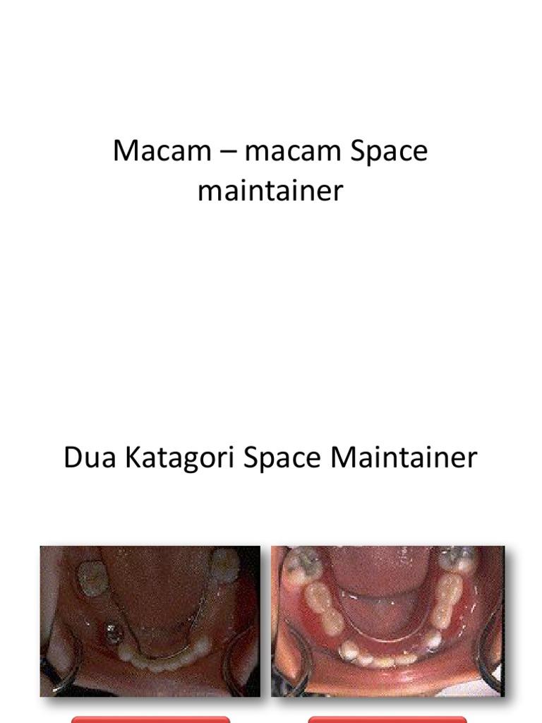 Macam - Macam Space Maintainer | PDF