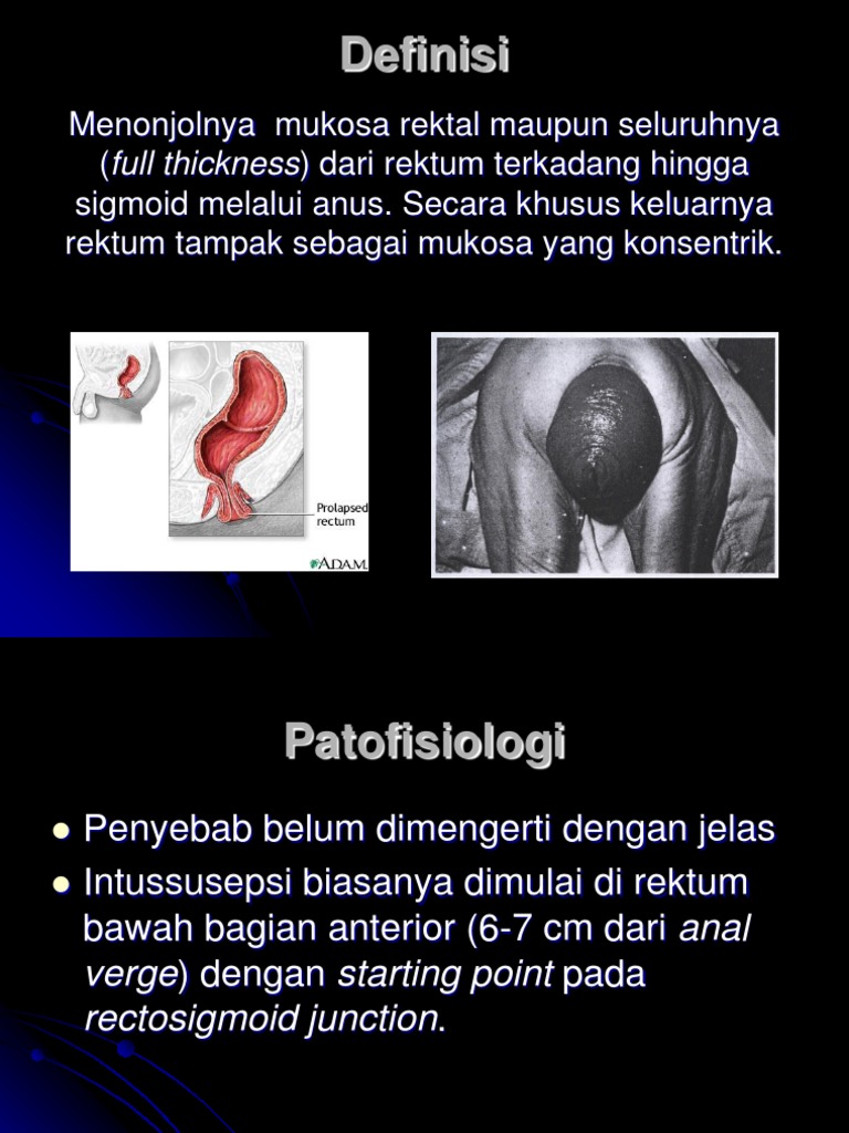 K - 22 Prolaps Recti (Bedah) | PDF