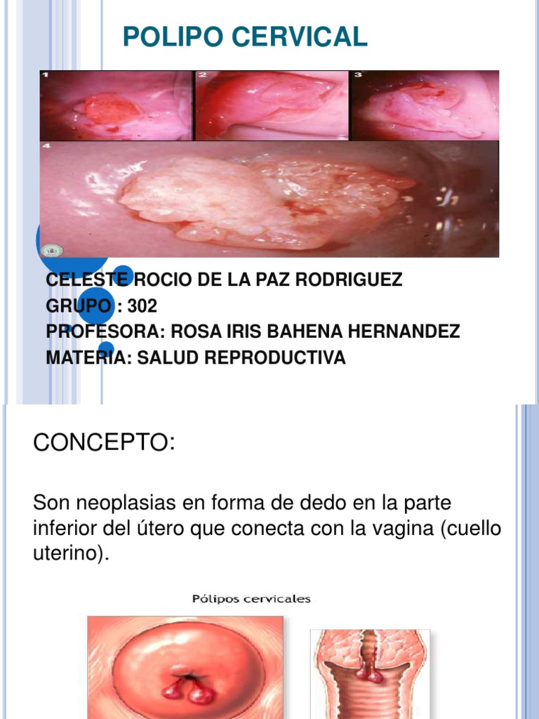 Pólipos cervicales: causas, síntomas y tratamiento | PDF | Vagina | Cáncer