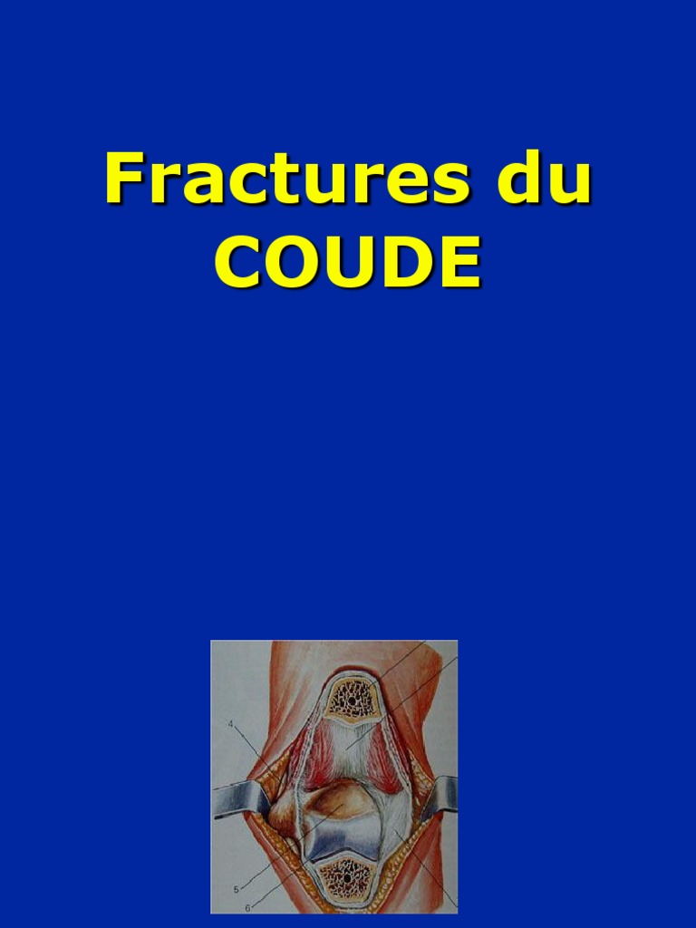 Fractures du Coude : Diagnostic et Traitement | PDF | Coude | Main