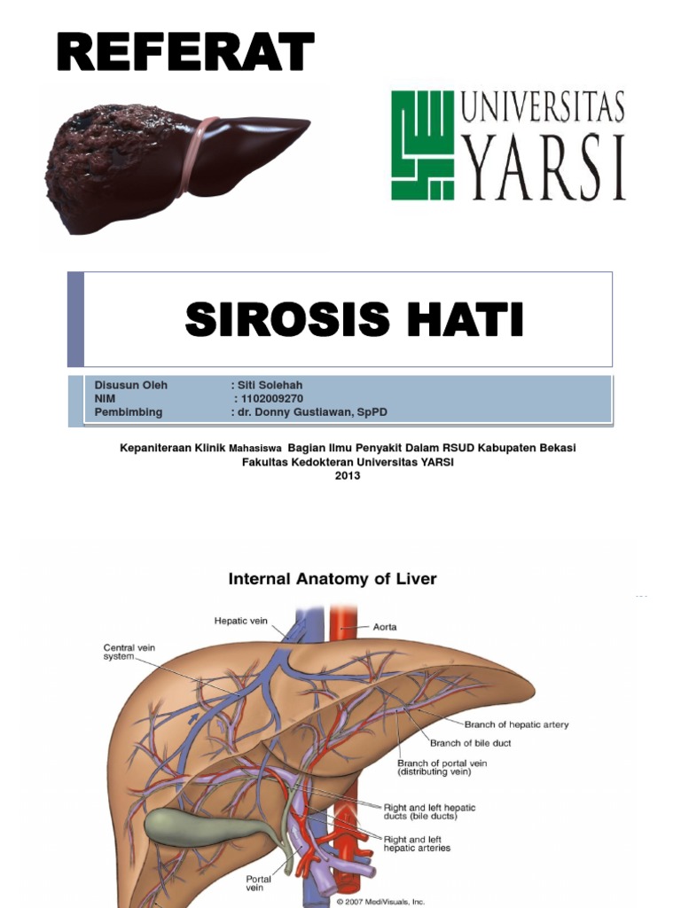 Sirosis Hati | PDF