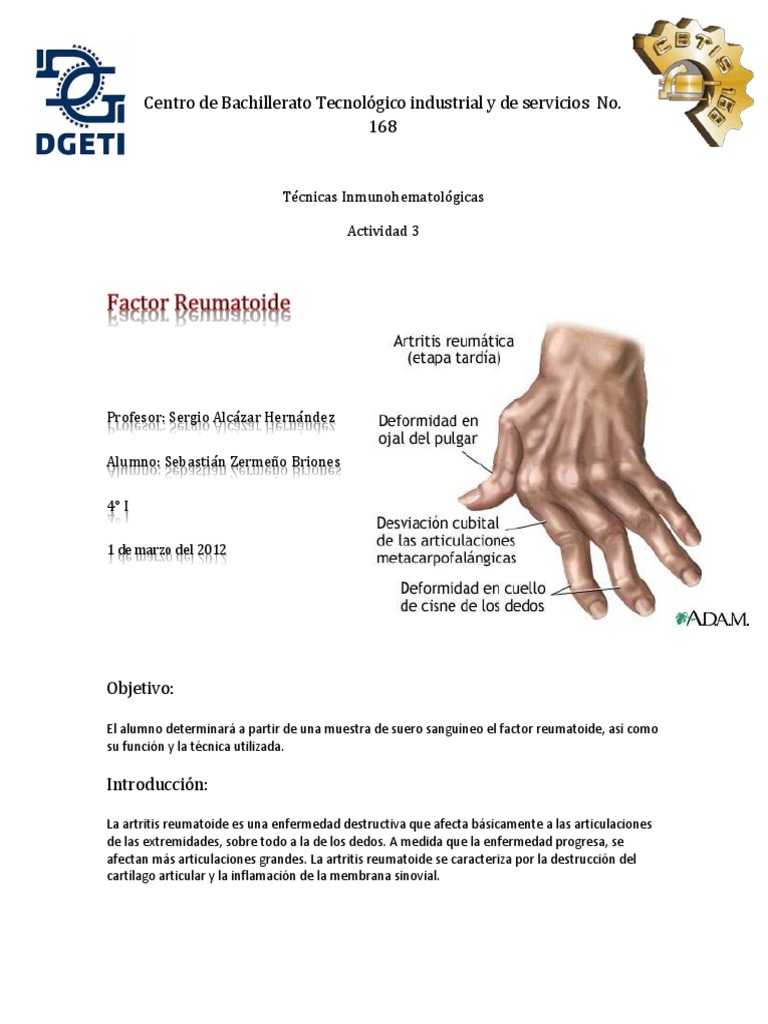 Práctica de Factor Reumatoide | Artritis Reumatoide | Anticuerpo