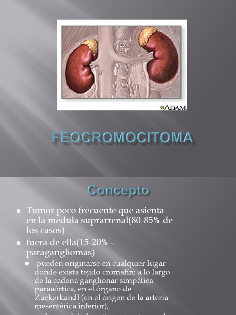Feocromocitoma | PDF | Glándula suprarrenal | Hipertensión