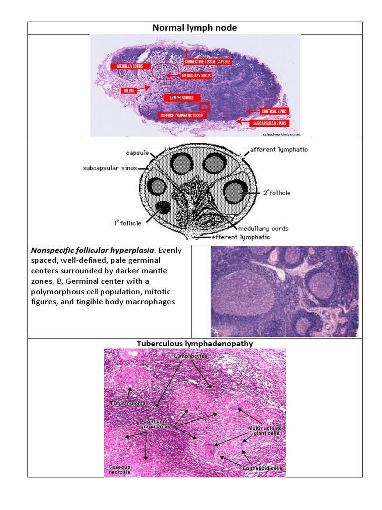 Lymph Node Pathology Overview | PDF