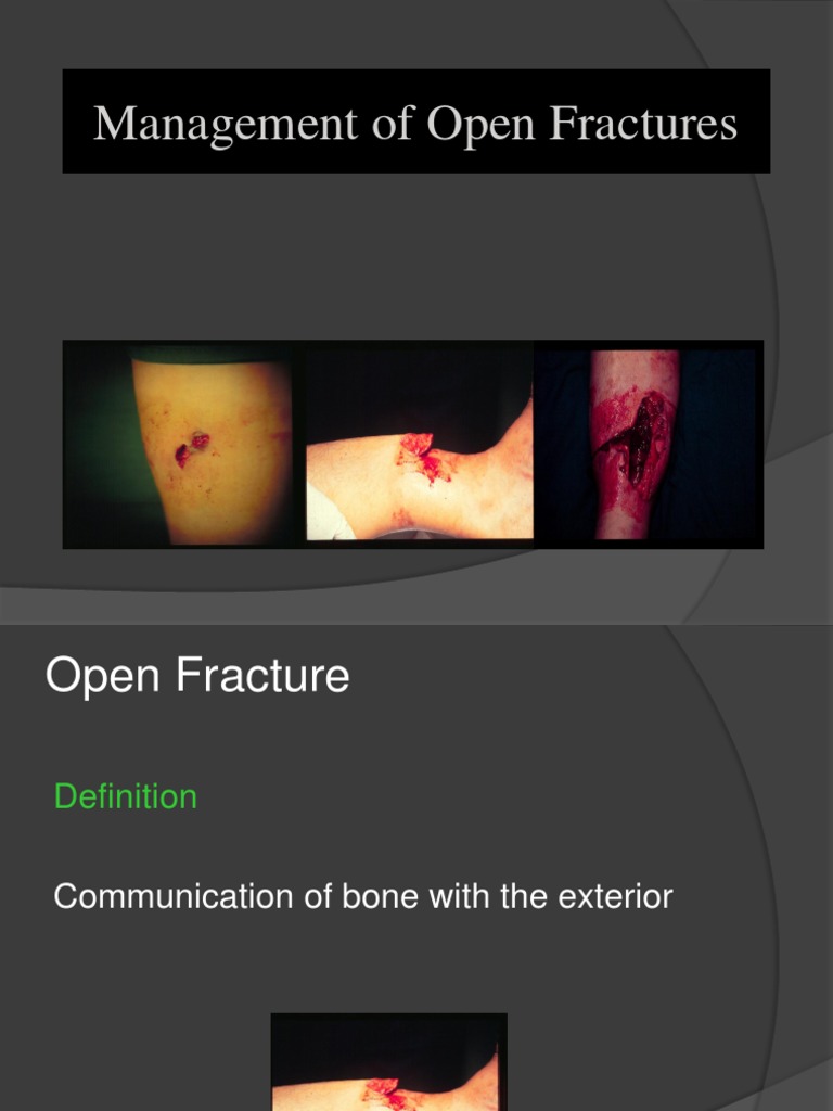 Open Fractures | PDF | Wound | Bone