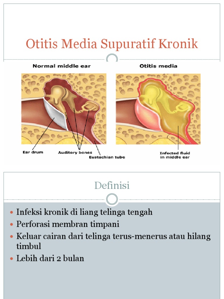 Otitis Media Supuratif Kronik | PDF