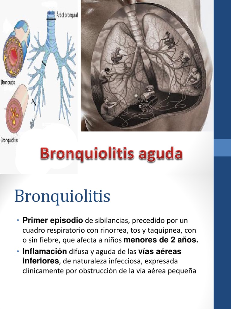 bronquiolitis aguda