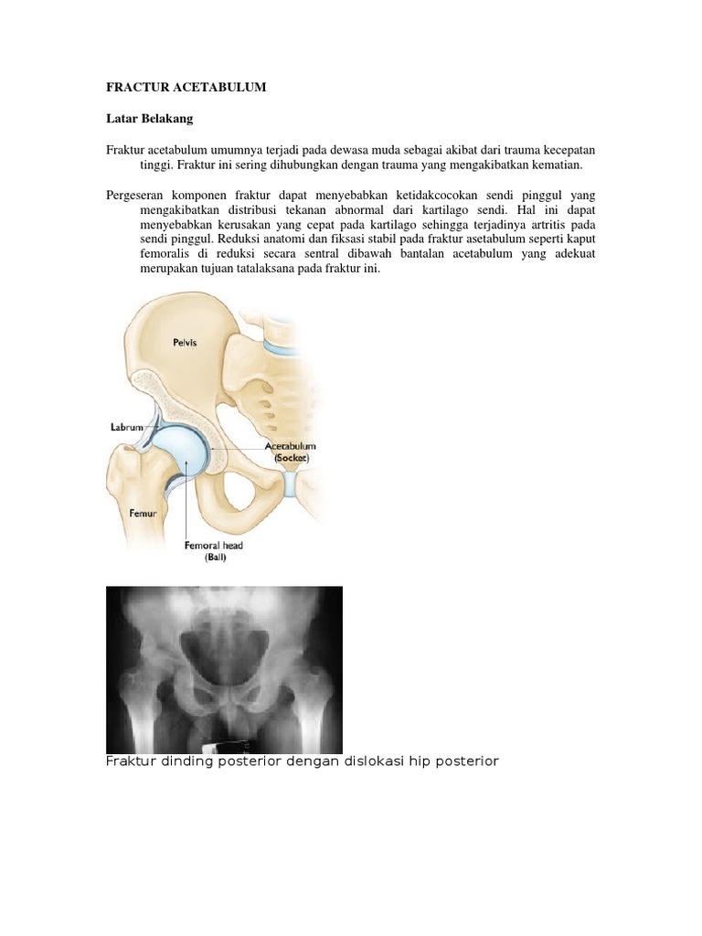 Klasifikasi dan Penanganan Fraktur Acetabulum | PDF