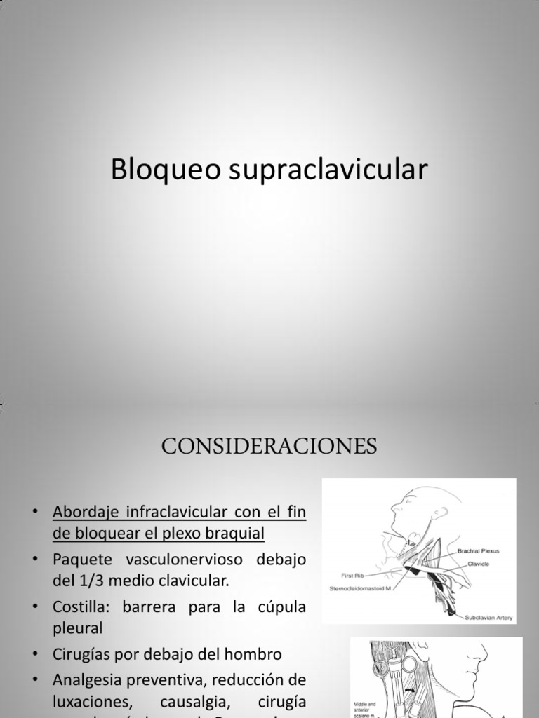 Bloqueo Supraclavicular | Anestesia | Especialidades Medicas