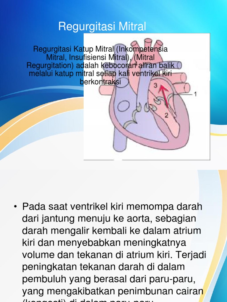 Regurgitasi Mitral | PDF