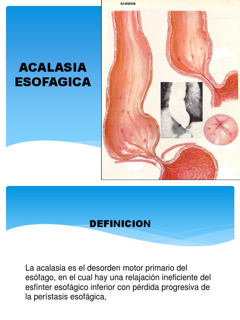 ACALASIA ESOFAGICA | Enfermedad del reflujo gastroesofágico ...