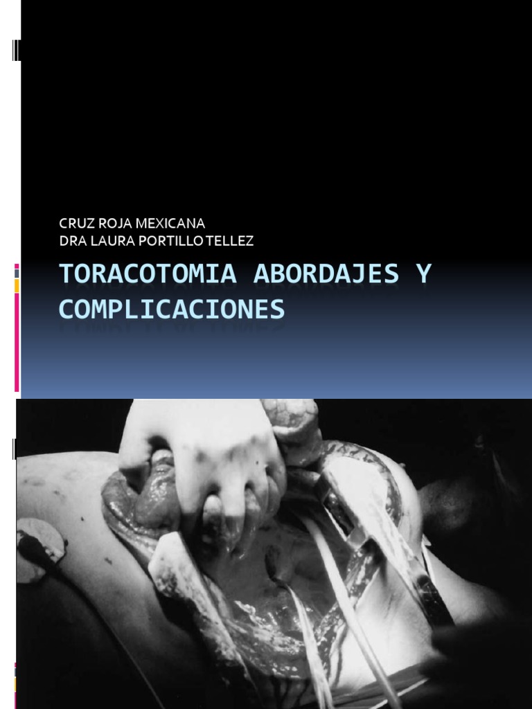 Toracotomia Abordajes y Complicaciones | PDF | Cáncer de pulmón | Pulmón