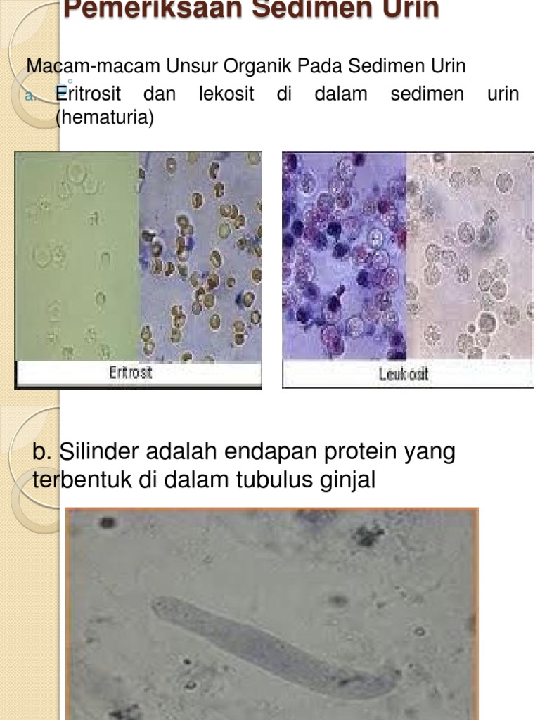 Pemeriksaan Sedimen Urin | PDF | Kesehatan Holistik | Sains & Matematika