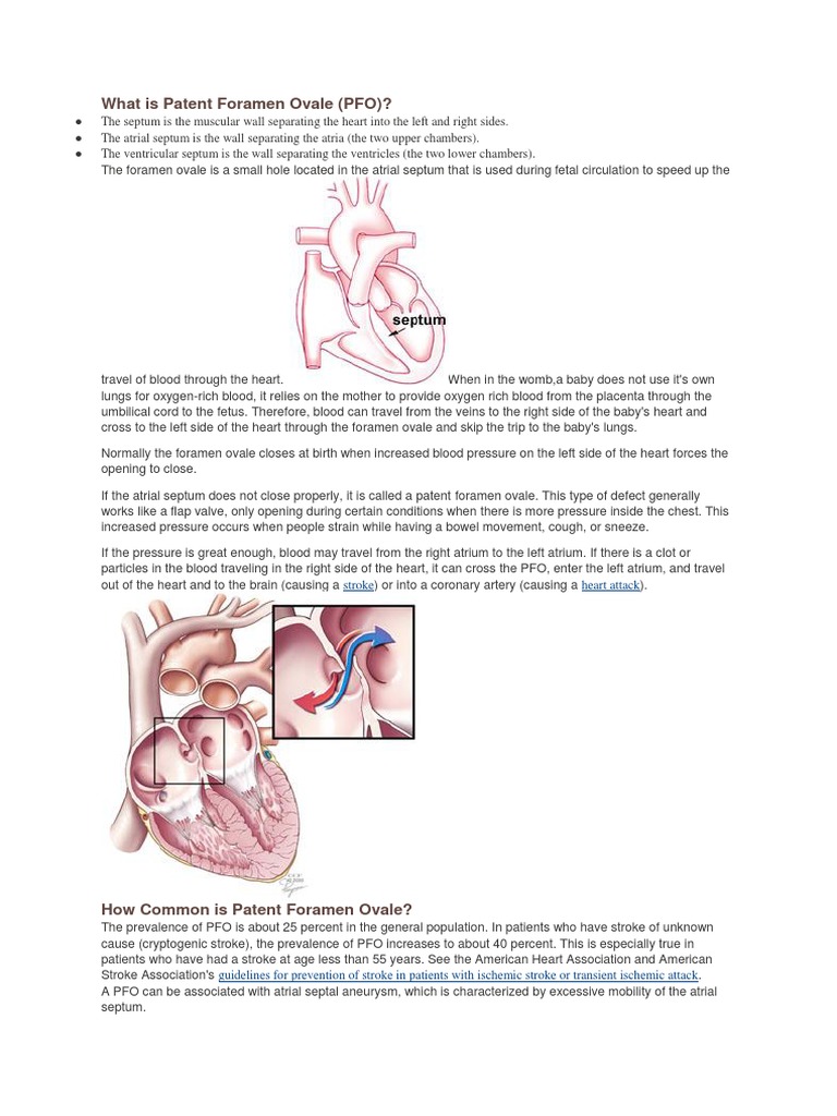 What is Patent Foramen Ovale.docx | Atrium (Heart) | Stroke