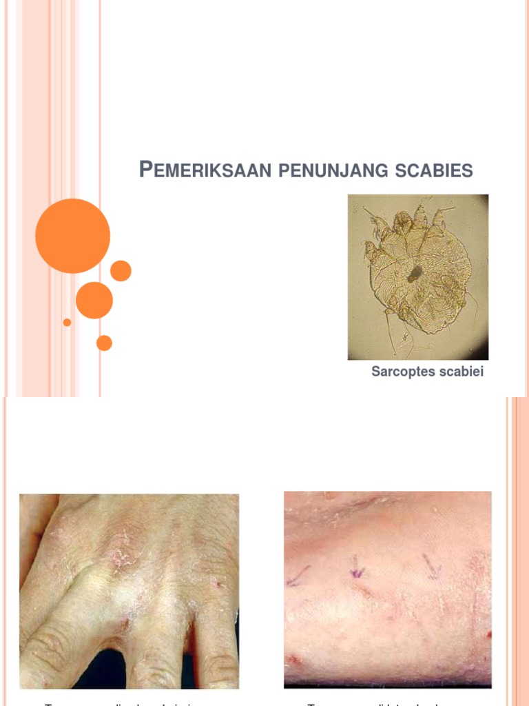 Pemeriksaan Penunjang Scabies | PDF