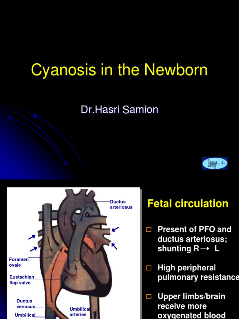 Cyanosis in the Newborn | Congenital Heart Defect | Heart