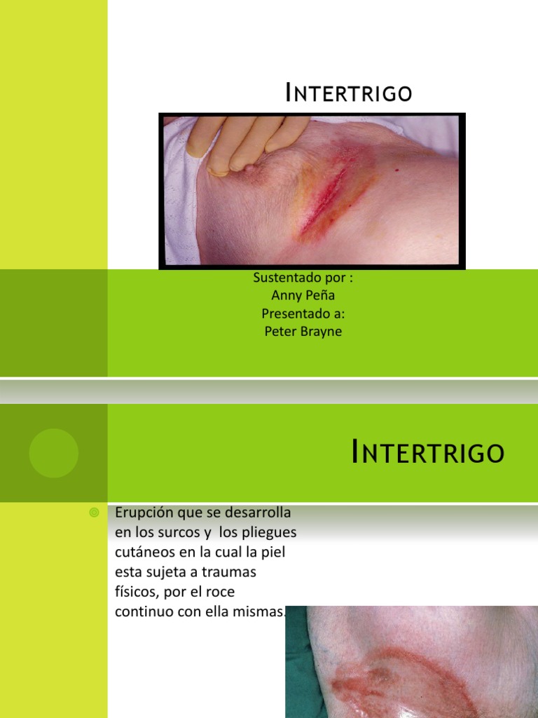 Intertrigo | PDF