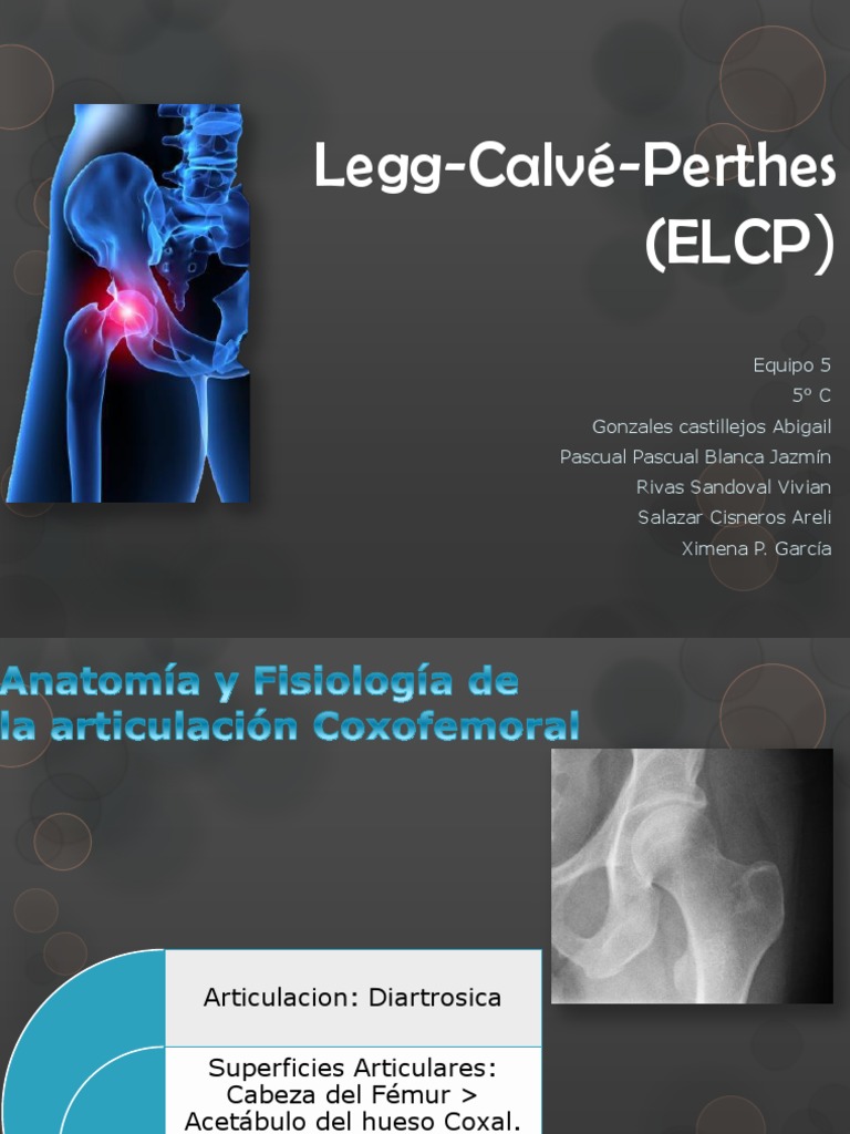 Legg Calvé Perthes (ELCP) | Cadera | Hueso