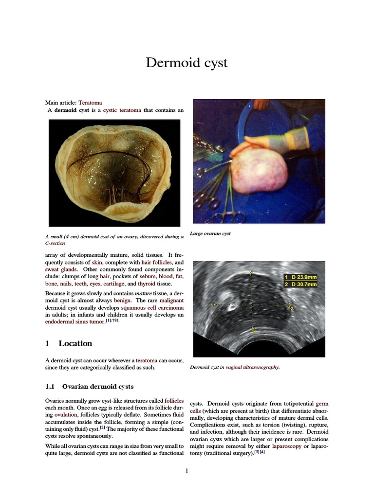 Dermoid Cyst Pdf Medicine Diseases And Disorders
